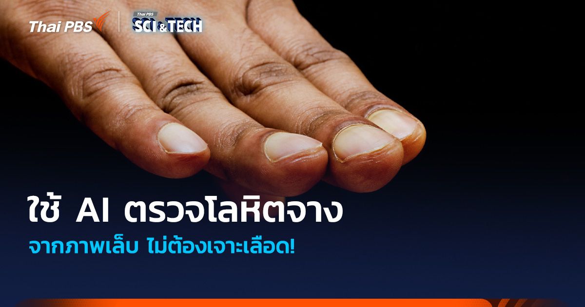 ไม่ต้องเจาะเลือด! พัฒนาแอปฯ ใช้ AI ตรวจโลหิตจางจากภาพเล็บ | Thai PBS NOW