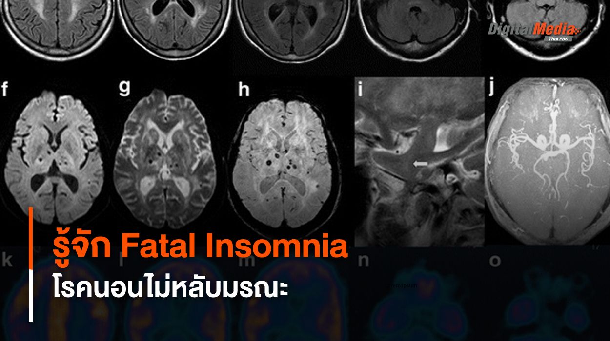 รู้จักโรคนอนไม่หลับมรณะ หรือ Fatal Insomnia ง่วงจนตาย | Thai PBS NOW