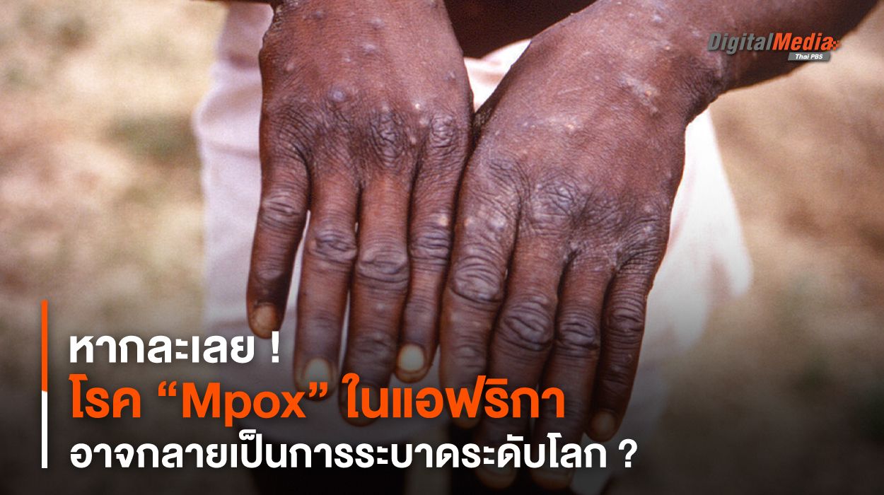 หากละเลย “Mpox” ในแอฟริกา อาจกลายเป็นการระบาดระดับโลก ? | Thai PBS NOW