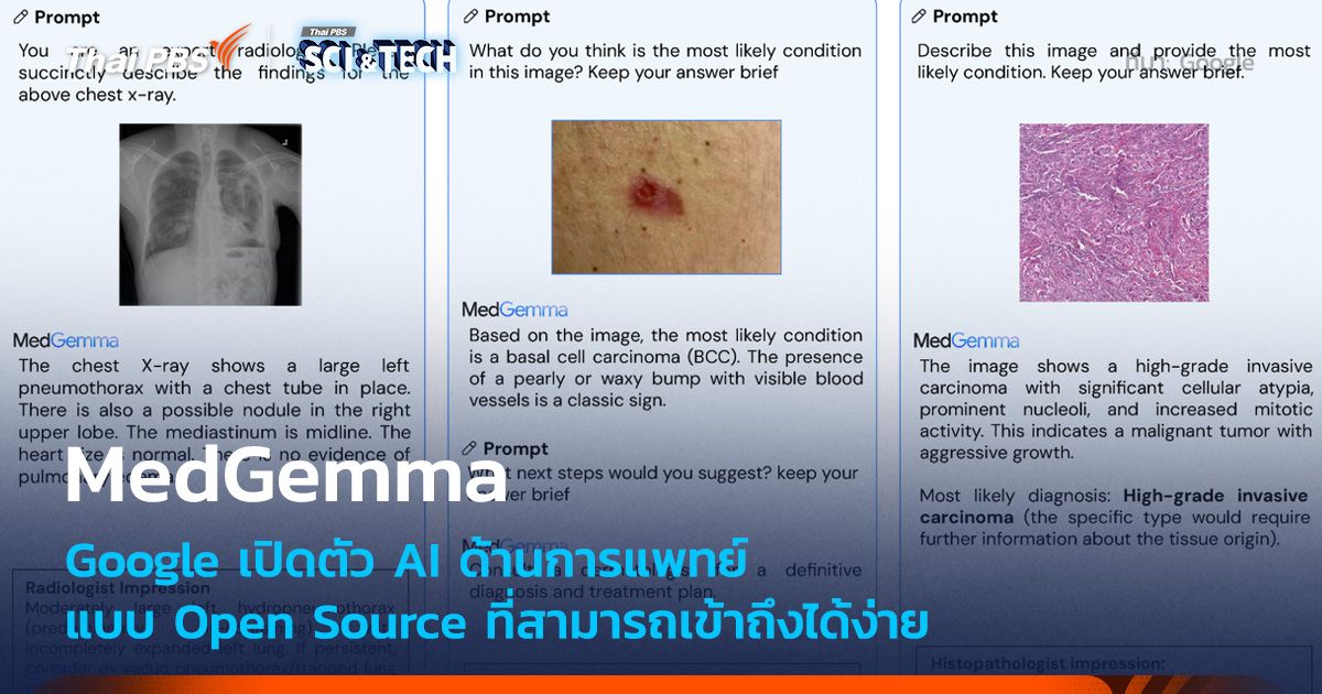 Google เปิดตัว MedGemma AI Opensource ด้านการแพทย์ | Thai PBS NOW